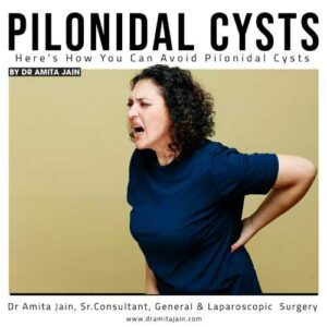 Here’s How You Can Avoid Pilonidal Cysts by Dr Amita Jain