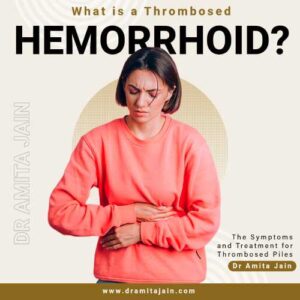 What is a Thrombosed Hemorrhoid? Symptoms and Treatment