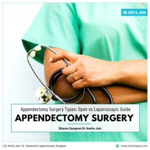 Open or Laparoscopic Appendectomy: What’s the Difference?