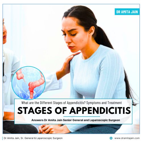 What are the Different Stages of Appendicitis? Symptoms and Treatment