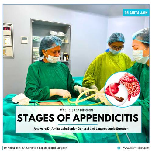 What are the Different Stages of Appendicitis? Symptoms and Treatment